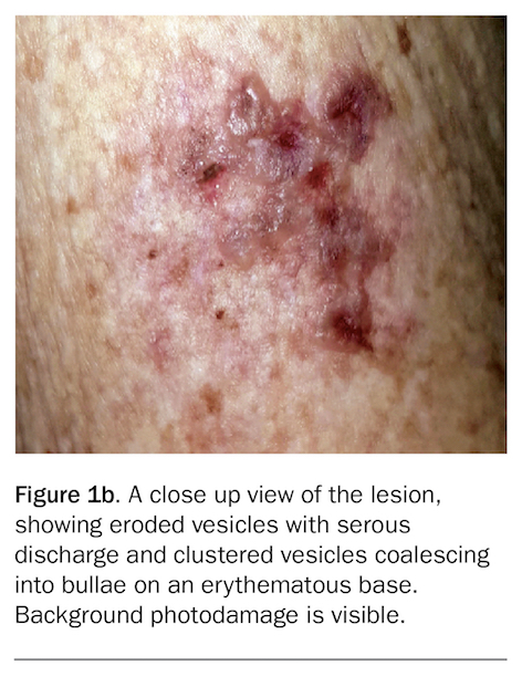 Vesicle Skin Lesion
